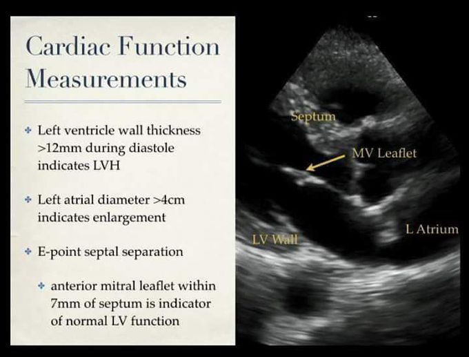 Important measurements of echo - MEDizzy