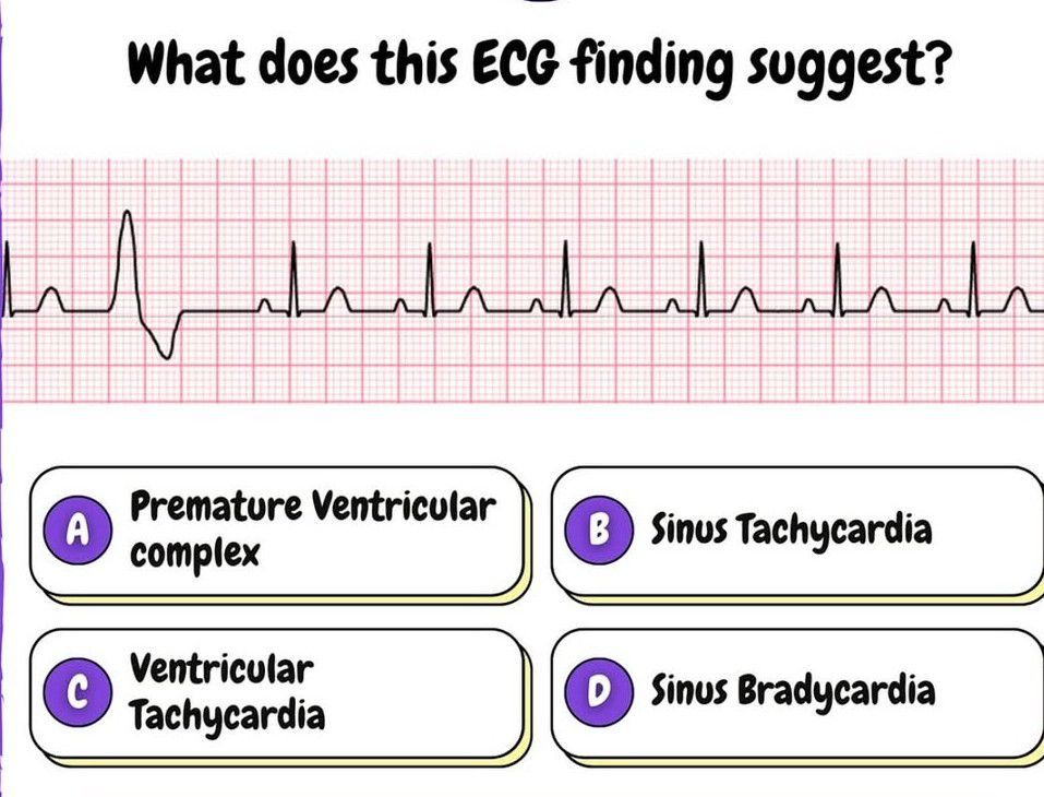 Identify the ECG Finding - MEDizzy
