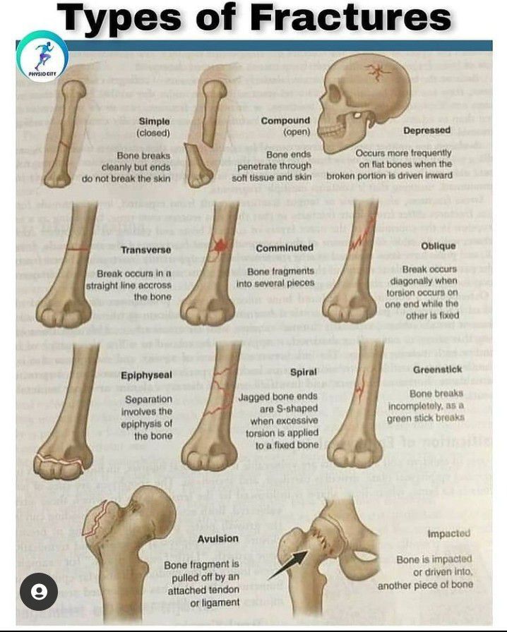 Types of fractures - MEDizzy
