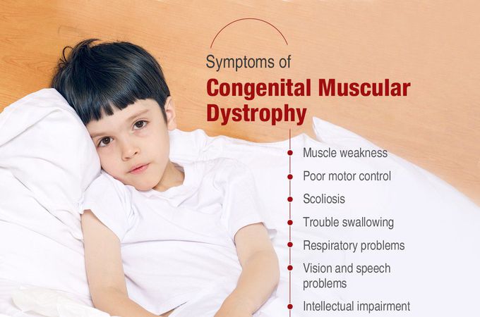 Congenital muscular dystrophy - MEDizzy