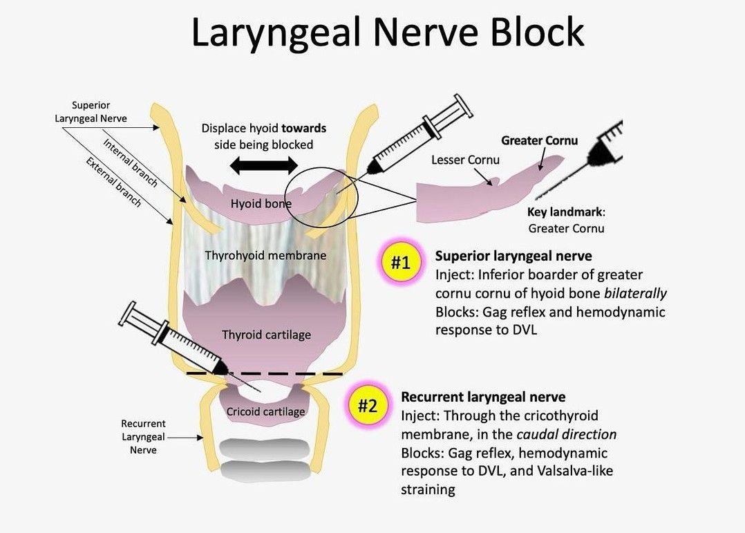 Laryngeal Nerve Block - MEDizzy