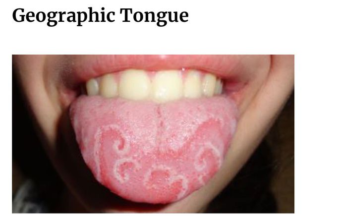 Geographic tongue - MEDizzy