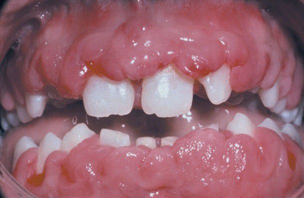 Cyclosporine-Related Gingival Hyperplasia - MEDizzy