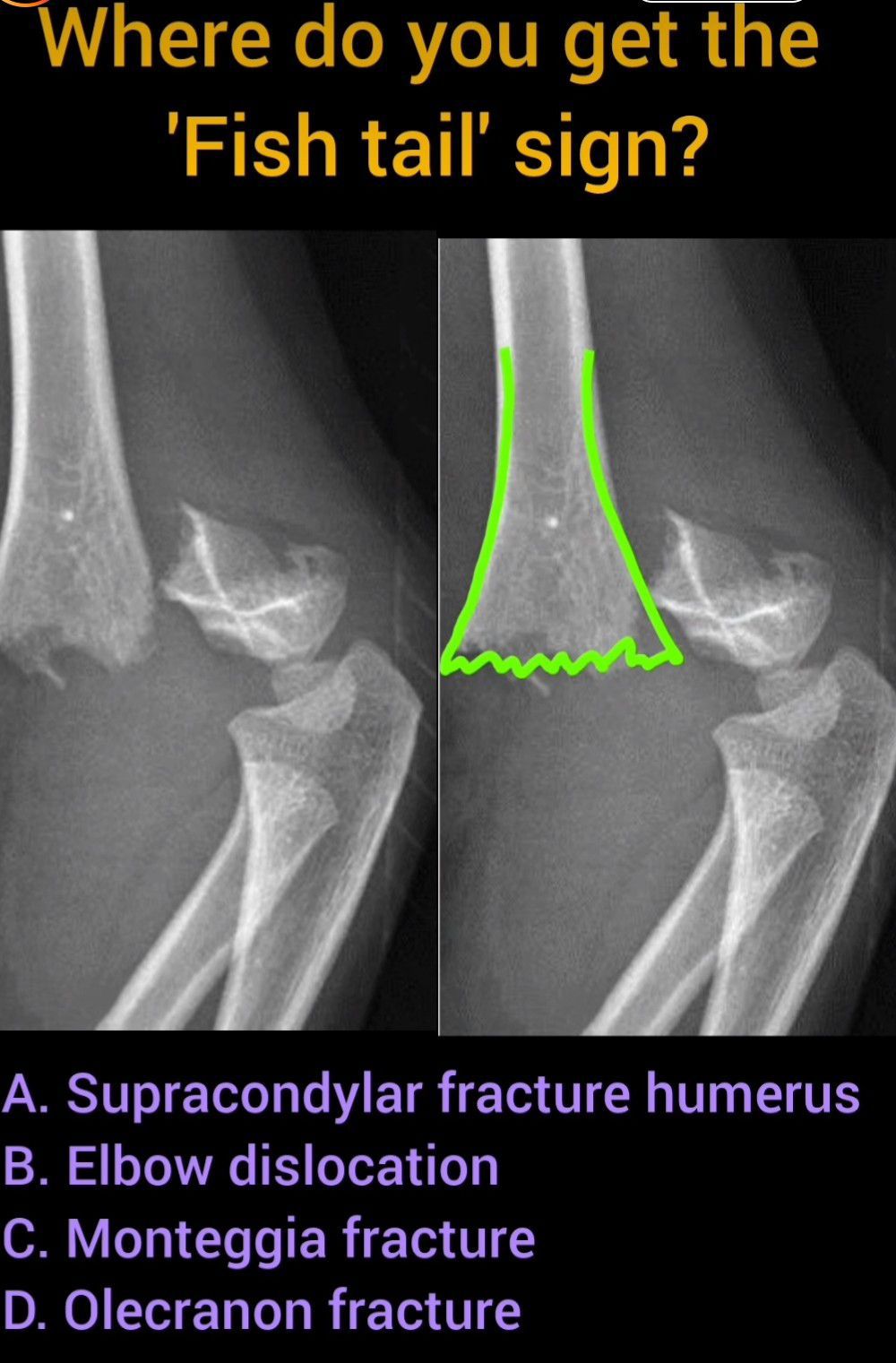 Fish Tail Sign - MEDizzy