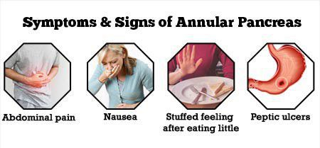 Symptoms of annular pancreas - MEDizzy