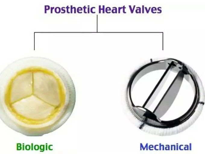 Prosthetic Heart Valves MEDizzy