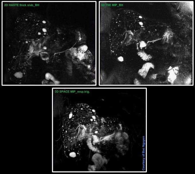 MRCP techniques @ Siemens 3T Skyra Different approach to - MEDizzy