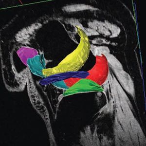 Cartilage morphology using MRI - MEDizzy