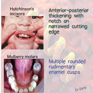 Oral Clinical features of Congenital syphilis - MEDizzy
