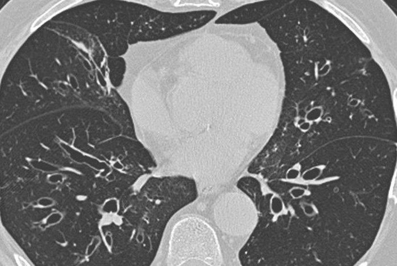 Bronchiectasis - MEDizzy