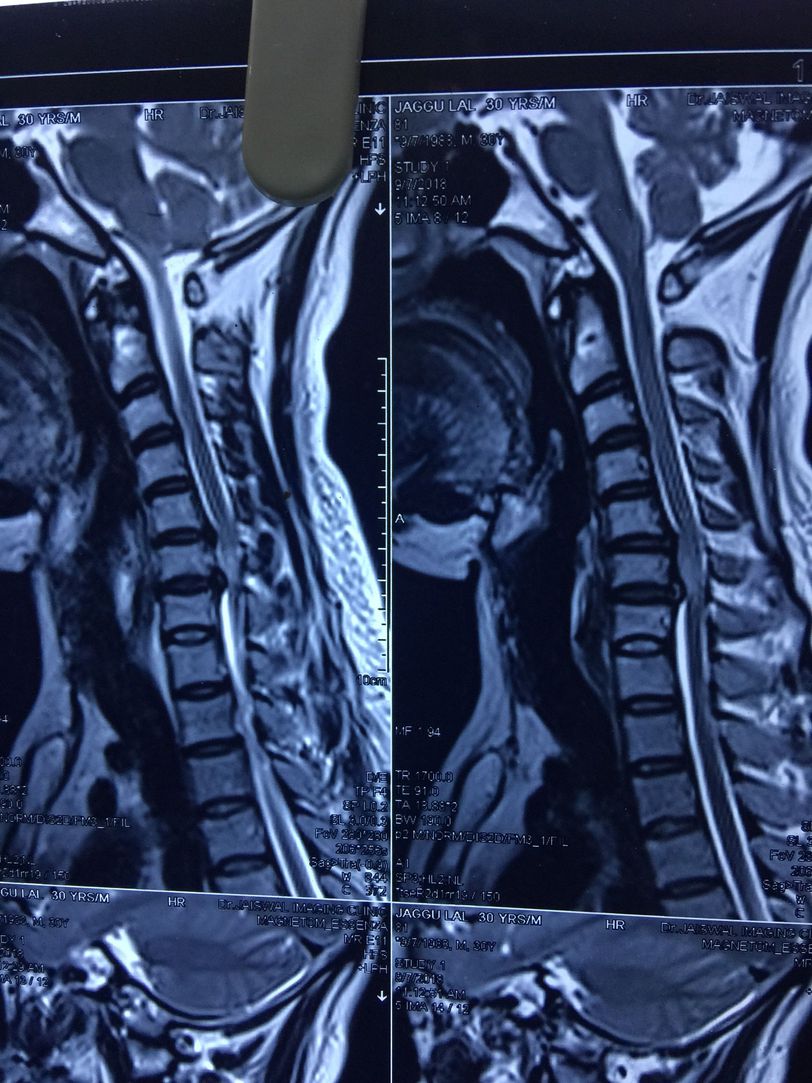 Quadriplegic, power 3/5 all 4 limbs - MEDizzy