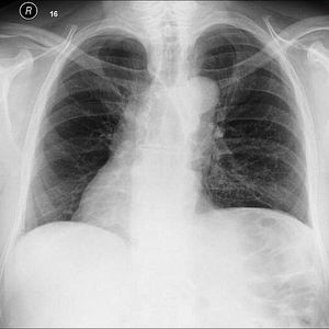 Dextrocardia - MEDizzy