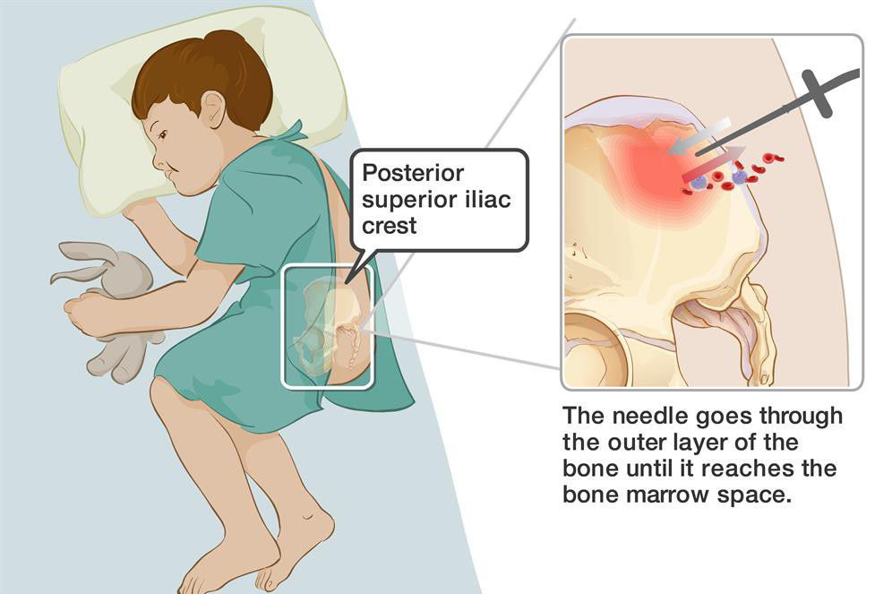 Bone marrow transplant. - MEDizzy