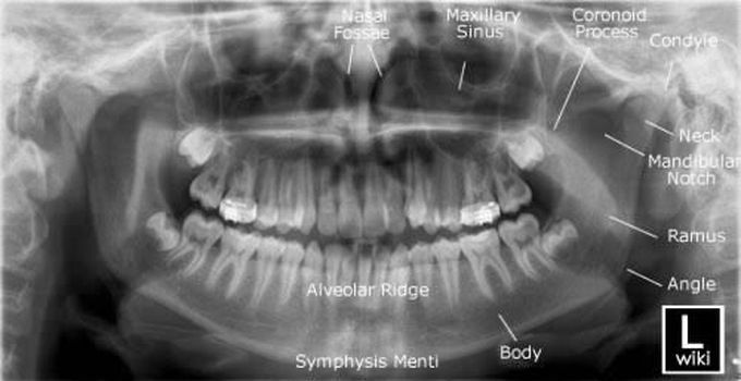 Indications for OPG - MEDizzy
