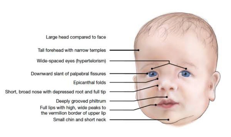 Mild Hypertelorism Causes