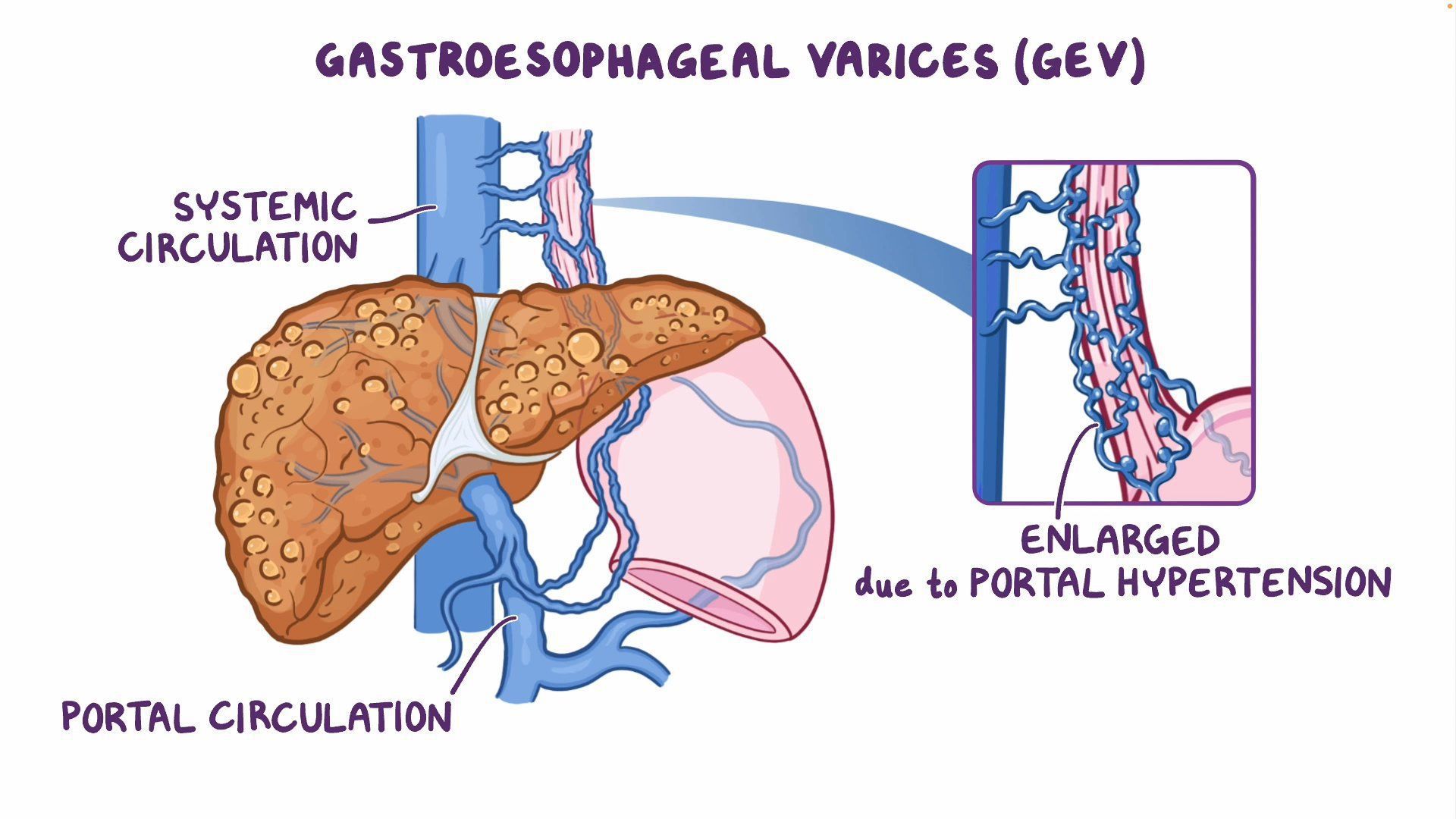 Treatment Of Esophageal Varices MEDizzy
