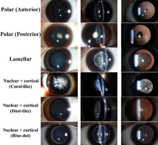 Slit Lamp Images Of Cataracts MEDizzy