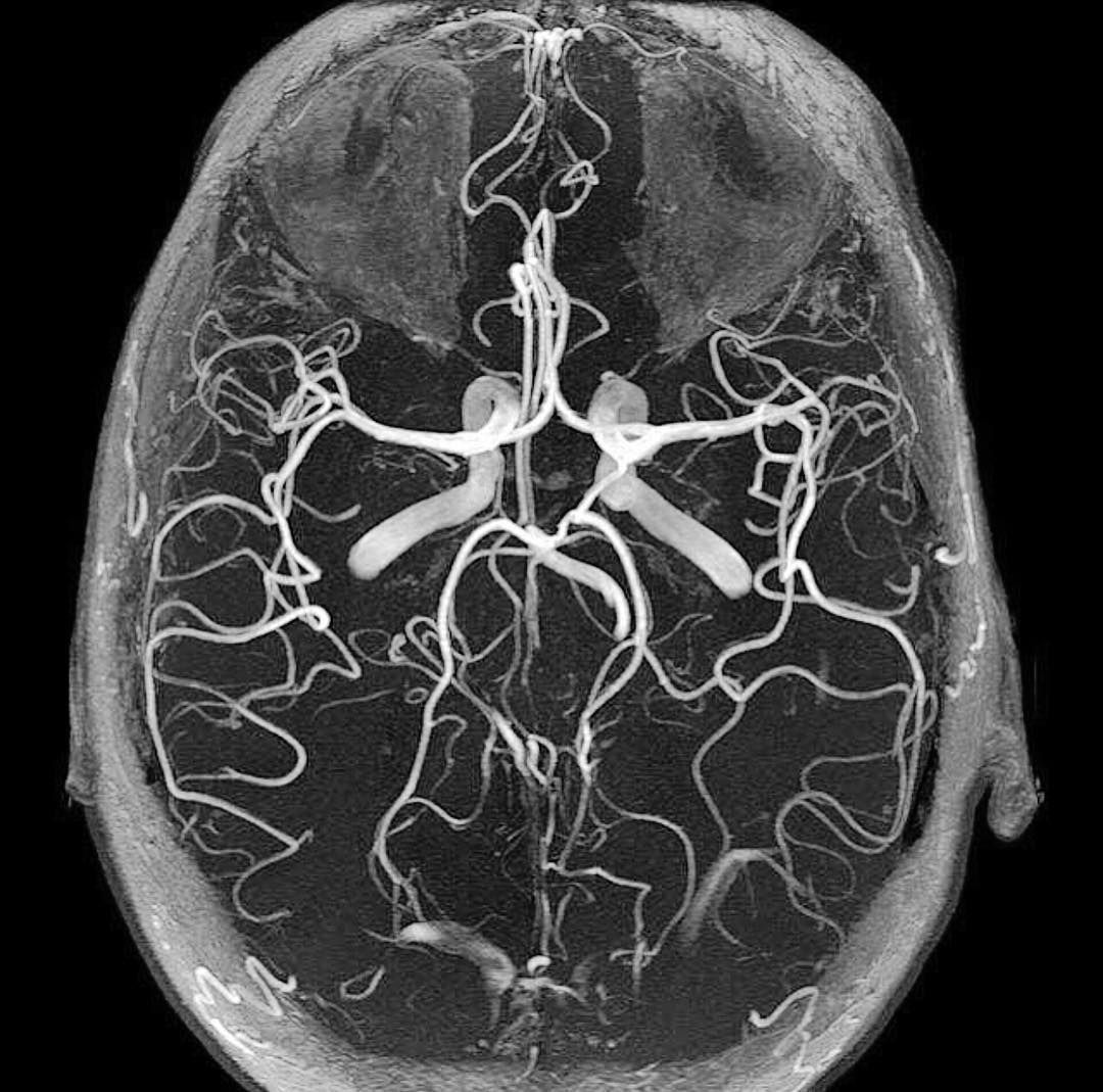 Circle Of Willis Anatomy Mri Moya Moya | Image | Radiopaedia.org