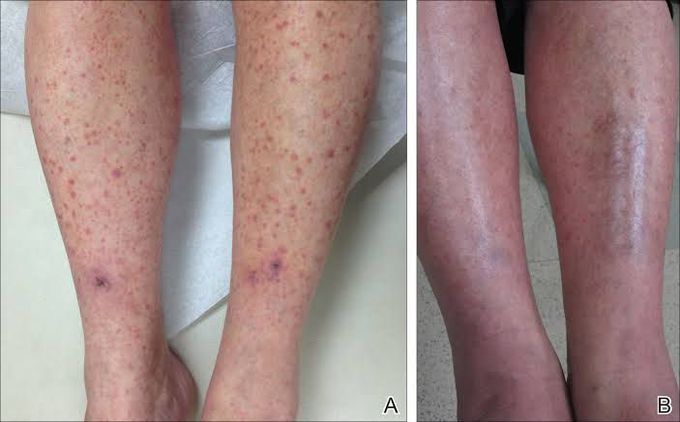 Vasculitis - MEDizzy
