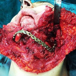Hemimandibulectomy due to osteosarcoma and reconstruction - MEDizzy
