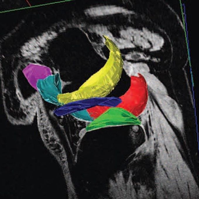 Cartilage morphology using MRI - MEDizzy