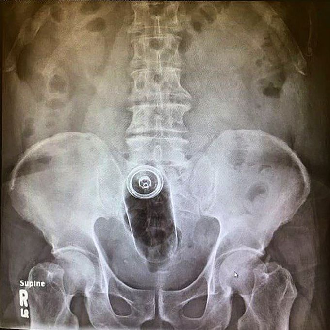 Foreign body in rectum - MEDizzy