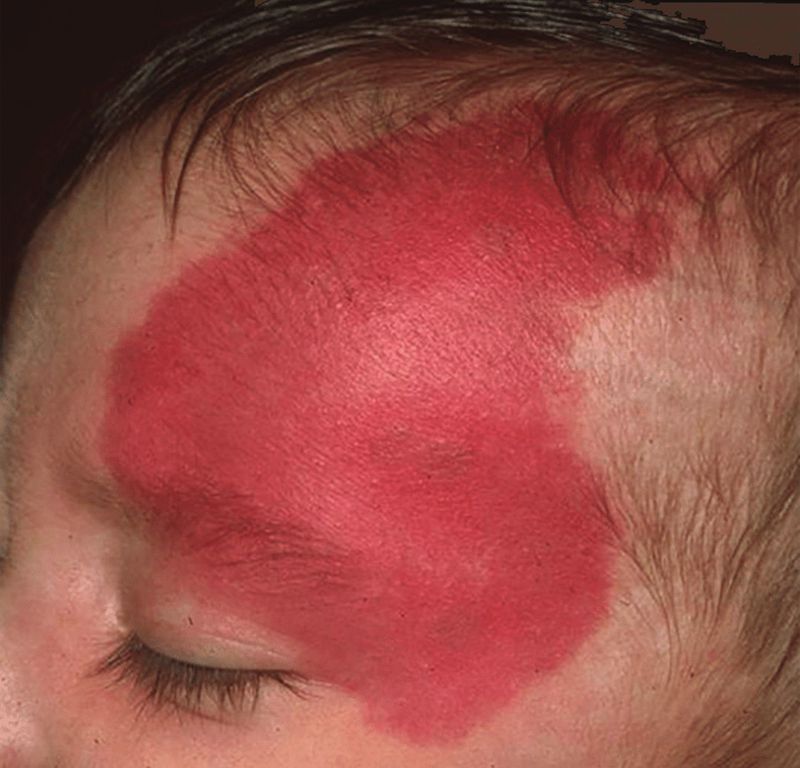 Nevus Flammeus