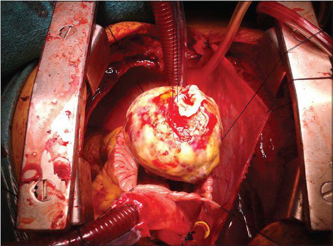 A solid ovoid left atrial myxoma - a tumor inside the heart! - MEDizzy