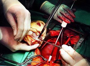 Transplantation on process!! - MEDizzy