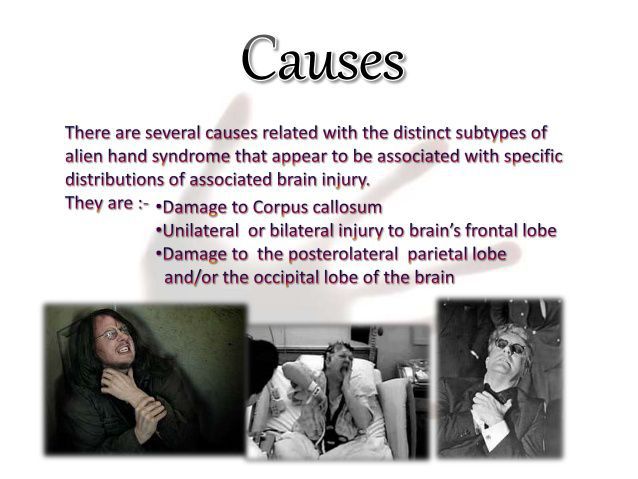 Alien Hand Syndrome