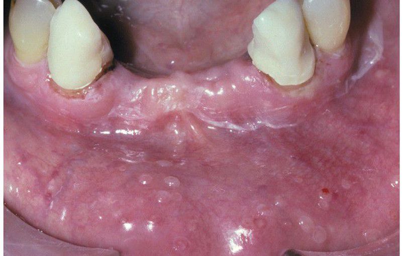 Irritant Contact Stomatitis
