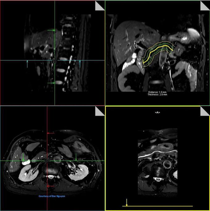 Pancreas Imaging @ Siemens 3T Skyra . Isotropic 1.5mm t2w - MEDizzy