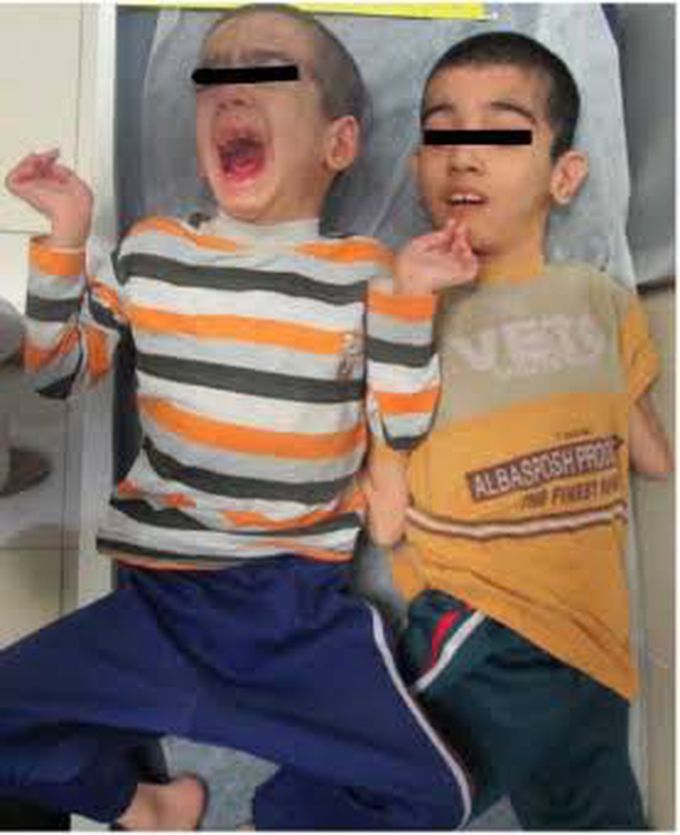 Pelizaeus-Merzbacher Disorder (PMD) - MEDizzy