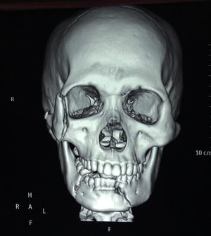 Skull fracture - MEDizzy