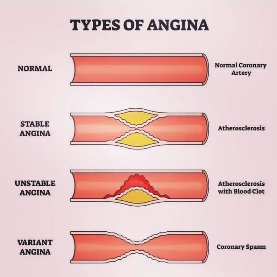 Types of Angina - MEDizzy