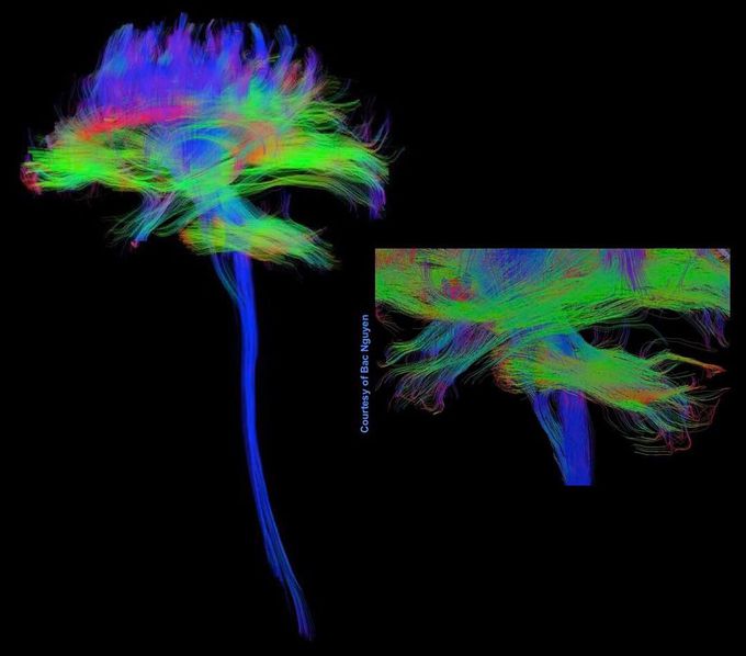 Diffusion Tensor Imaging (DTI) @ Siemens 3T Prisma. - MEDizzy