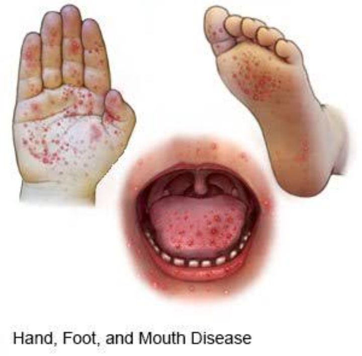 Foot and mouth disease - MEDizzy