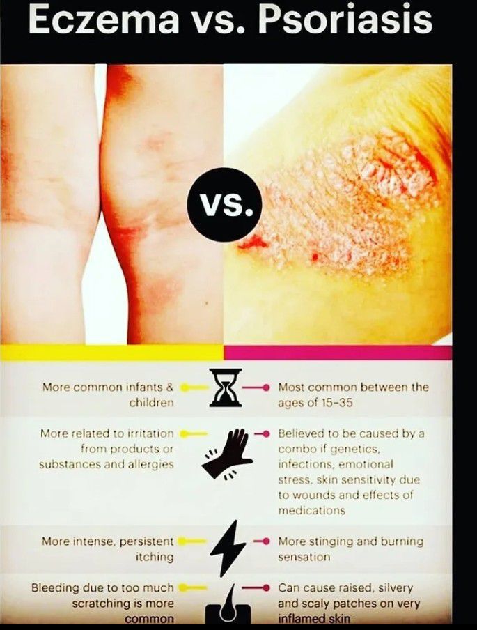 Eczema vs Psoriasis - MEDizzy