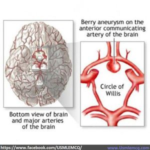 berry aneurysm - MEDizzy