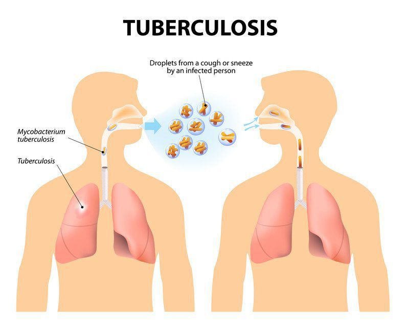 Tuberculosis - MEDizzy