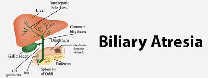 Biliary atresia - MEDizzy