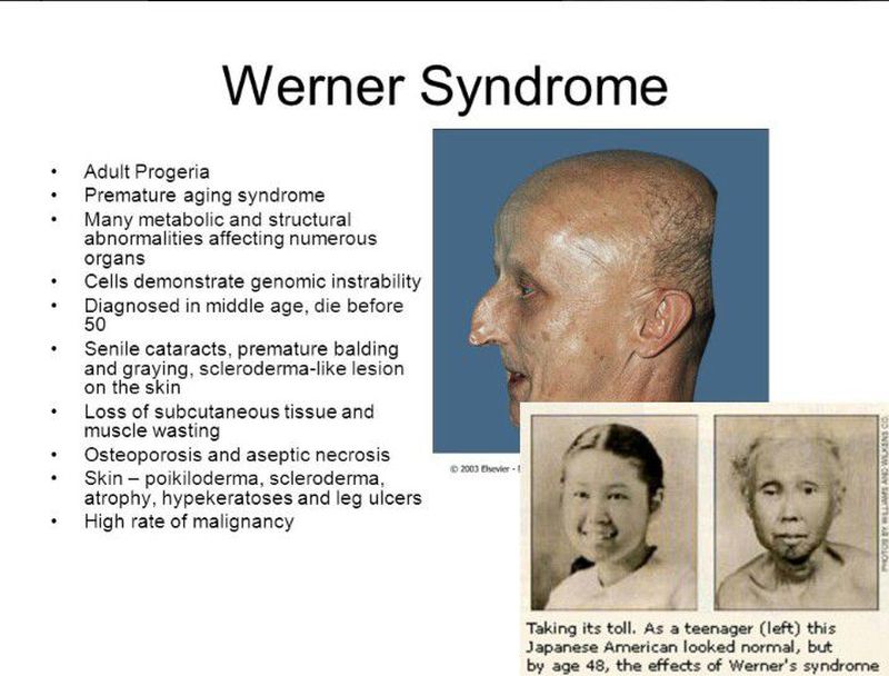 Werner S Syndrome