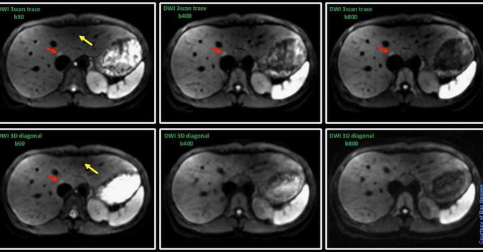 MRI Liver Imaging - DWI 3scan trace vs. 3D diagonal @ - MEDizzy