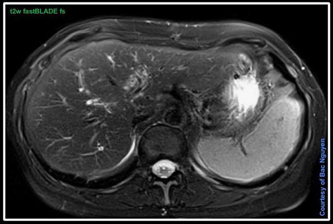 t2w fastBLADE fs liver imaging @ Siemens 3T Prisma This is - MEDizzy