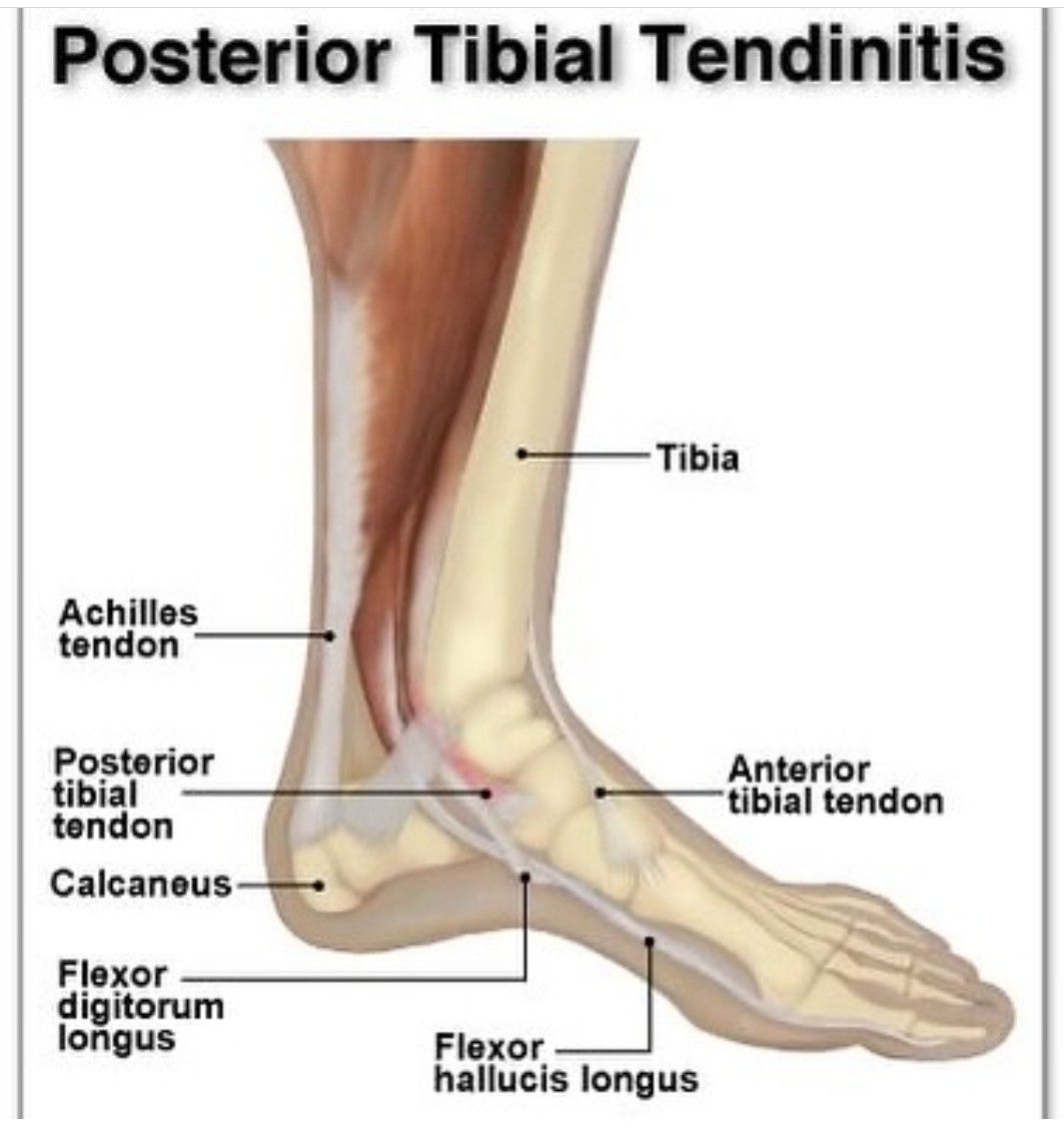 Posterior Tibial Tendinitis MEDizzy