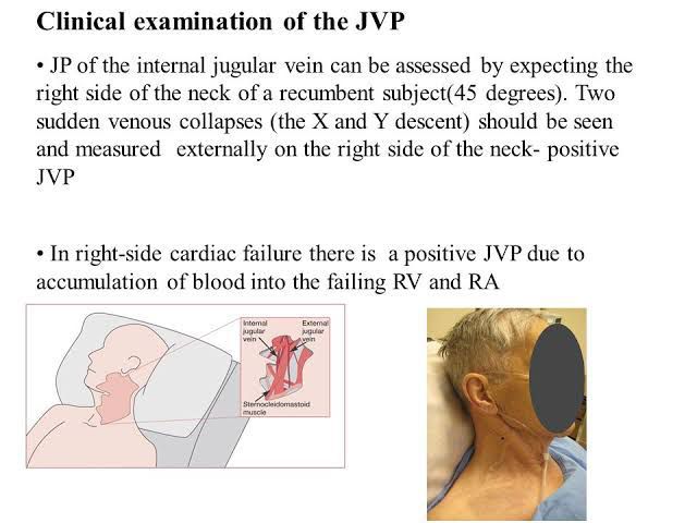 Jvd Vs Carotid