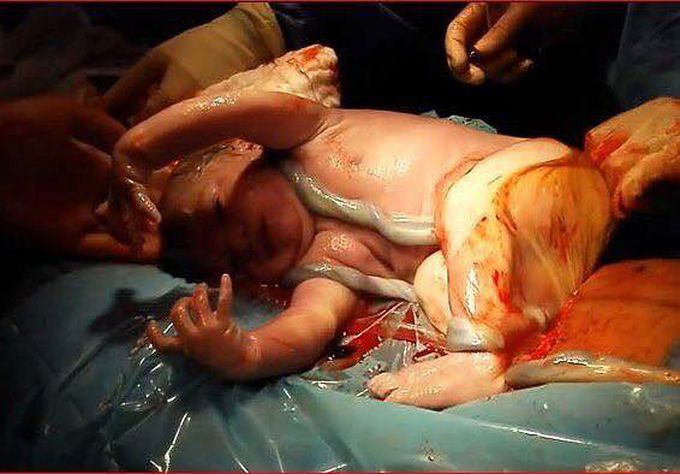 Amniotic sac removal - MEDizzy