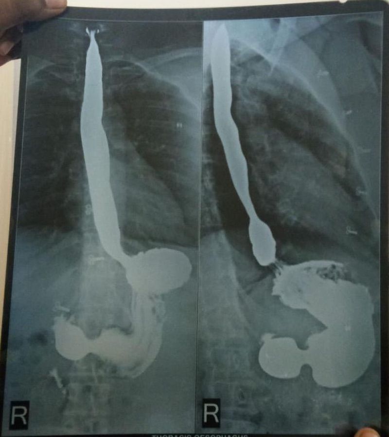 Barium meal swallow - MEDizzy