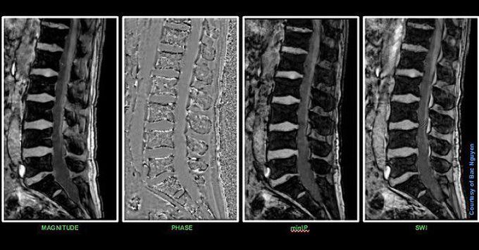 MR Neuro Imaging – Hemorrhage Spinal Cord part 2 @ Siemens - MEDizzy