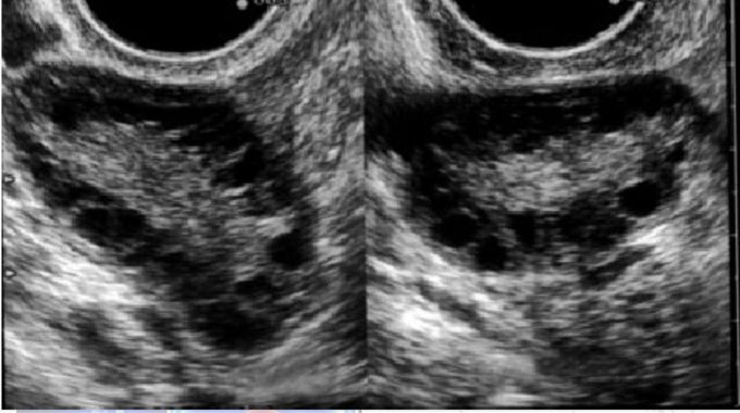 Polycystic ovarian - MEDizzy